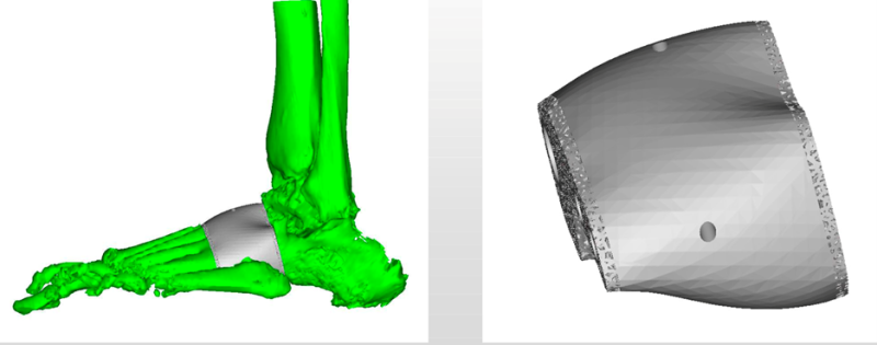 Bone Disintegration: Charcot Neuroarthropathy