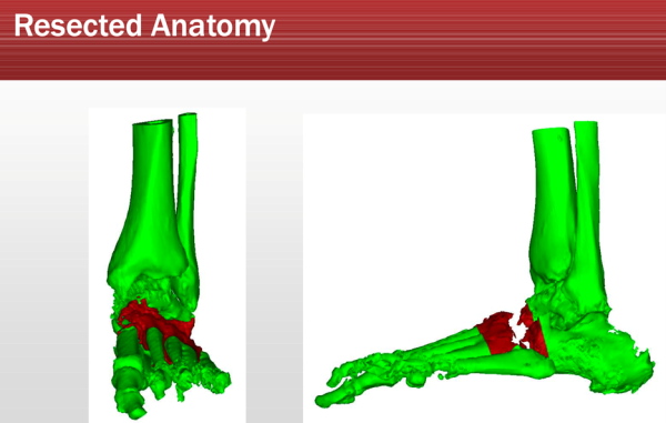 Bone Disintegration: Charcot Neuroarthropathy